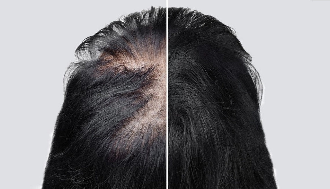 How to Prevent Hair Loss from Stress? – Biotin Xtreme Hair Care